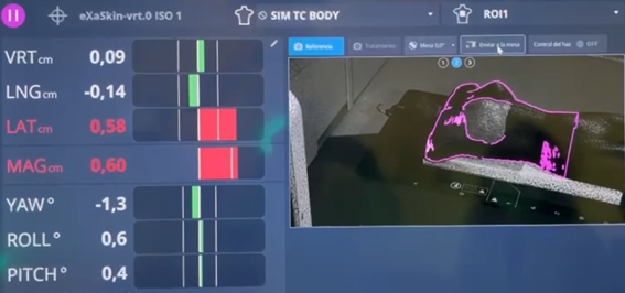 Surface Guided Radiotherapy and the Issue of Bolus Utilization